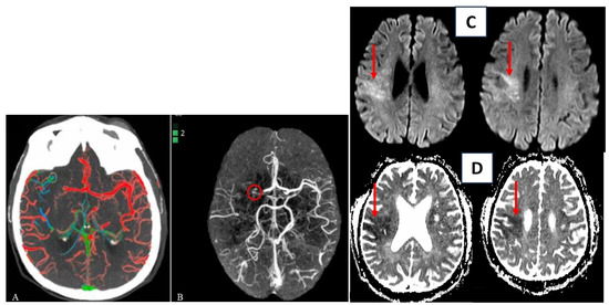 The Pathophysiology of Collateral Circulation in Acute Ischemic Stroke