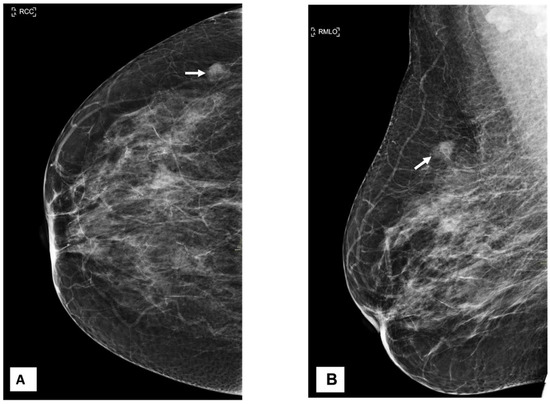 Diagnostics | Free Full-Text | Initial Imaging Findings of Breast Liposarcoma: A Case Report