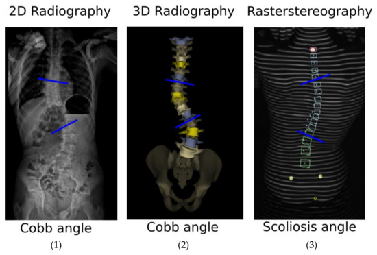 Three-Dimensional Spinal Evaluation Using Rasterstereography in Patients with Adolescent ...