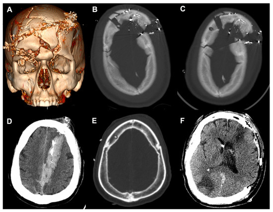 Power Drill Craniostomy for Bedside Intracranial Access in Traumatic ...