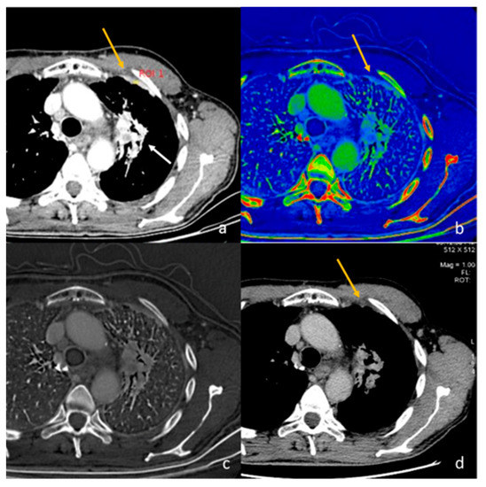 Thoracic Diseases: Technique and Applications of Dual-Energy CT