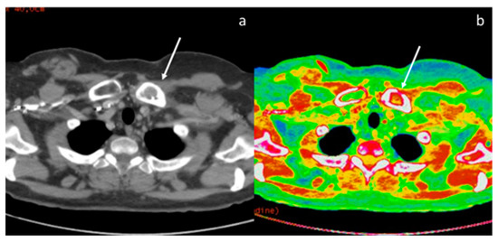 Thoracic Diseases: Technique and Applications of Dual-Energy CT
