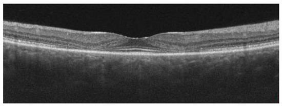 Early Optical Coherence Tomography Biomarkers for Selected Retinal ...