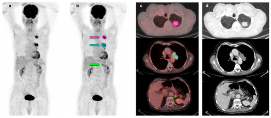 Diagnostics | Free Full-Text | Heterogeneity of Glycolytic Phenotype Determined by 18F-FDG PET ...