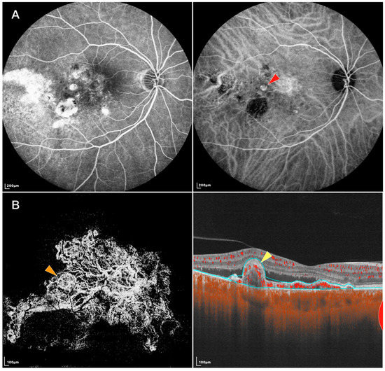 Recent Advances in Imaging Polypoidal Choroidal Vasculopathy with Swept ...