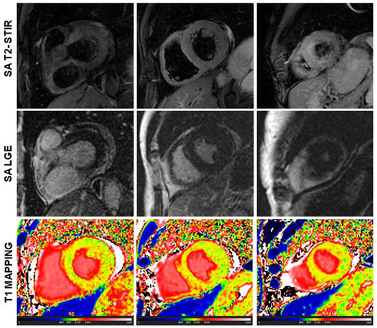 Diagnostics | Free Full-Text | Diagnostic Role of Native T1 Mapping ...