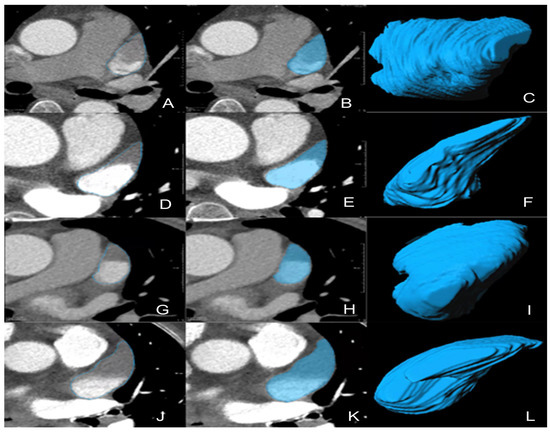 Radiomics Based on Single-Phase CTA for Distinguishing Left Atrial ...