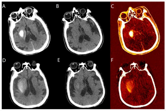 Hemorrhagic Transformation Assessment Based on Dual Energy CT of ...