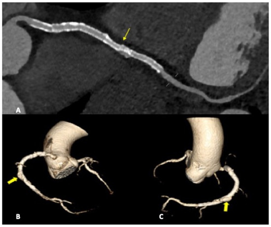 ECG-Gated CCTA in the Assessment of Post-Procedural Complications