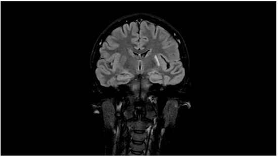 Diagnosis of Migrainous Infarction: A Case Report and Analysis of ...