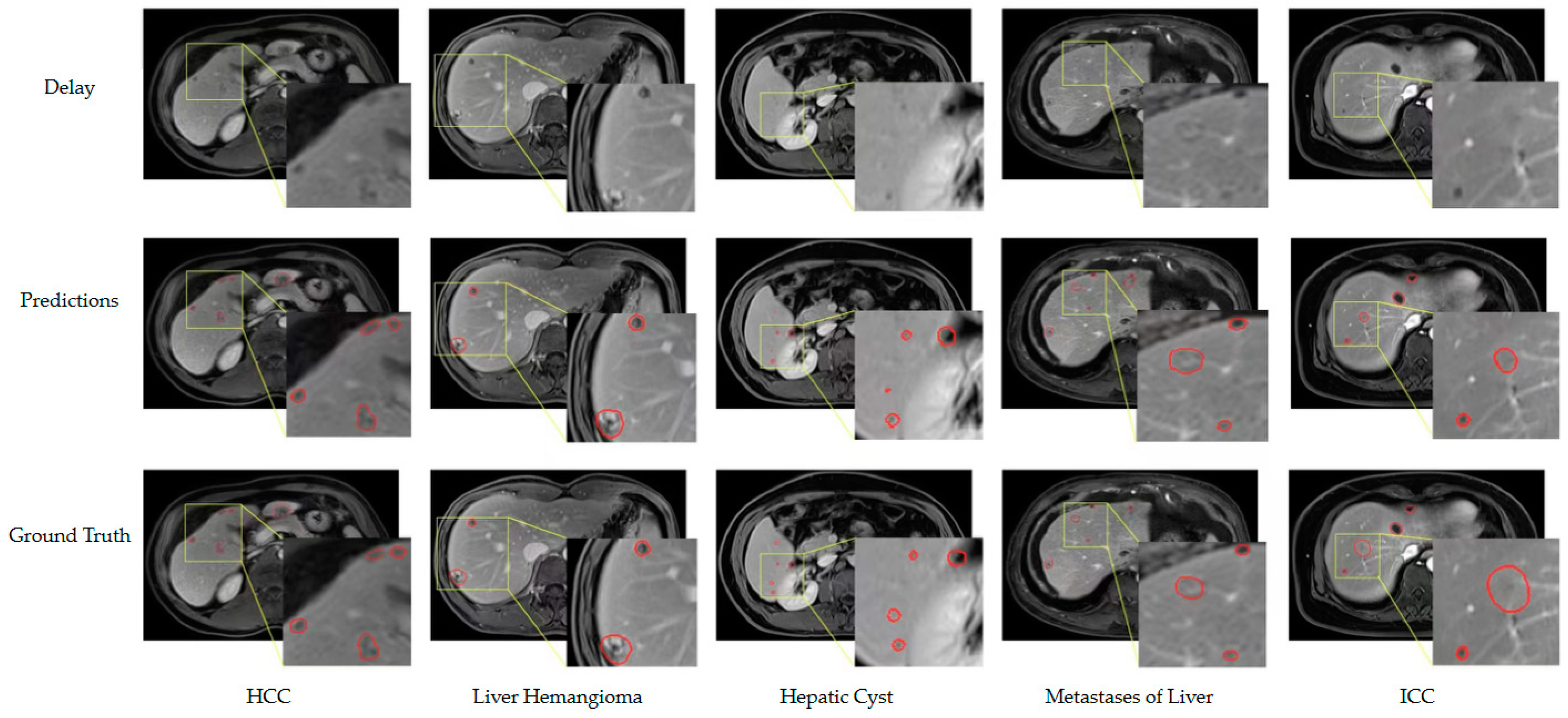 A Coarse-to-Fine Fusion Network for Small Liver Tumor Detection and ...