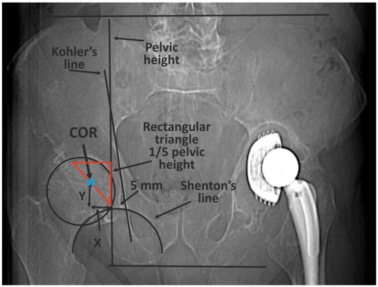 Optimization of Revision Hip Arthroplasty Workflow by Means of Detailed ...