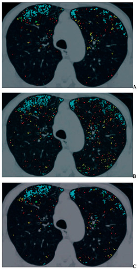 Area-Detector Computed Tomography for Pulmonary Functional Imaging