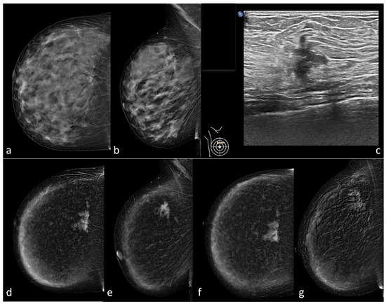 Diagnostic Performance of Contrast-Enhanced Digital Mammography versus Conventional Imaging in ...