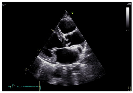 Echocardiographic Evaluation of Aortic Stenosis: A Comprehensive Review