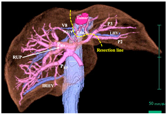 Laparoscopic Extended Left Lateral Sectionectomy for Hepatocellular ...