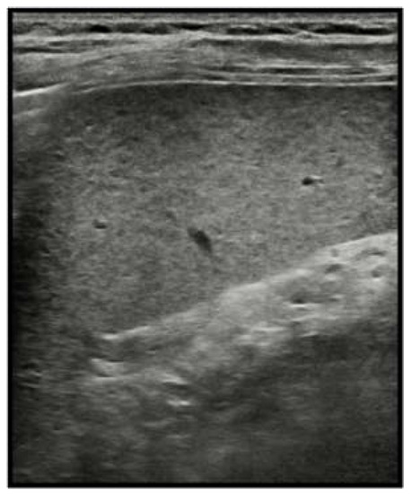 Incidental Focal Spleen Lesions: Integrated Imaging and Pattern ...