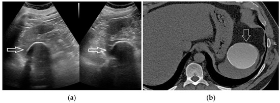 Incidental Focal Spleen Lesions: Integrated Imaging and Pattern ...