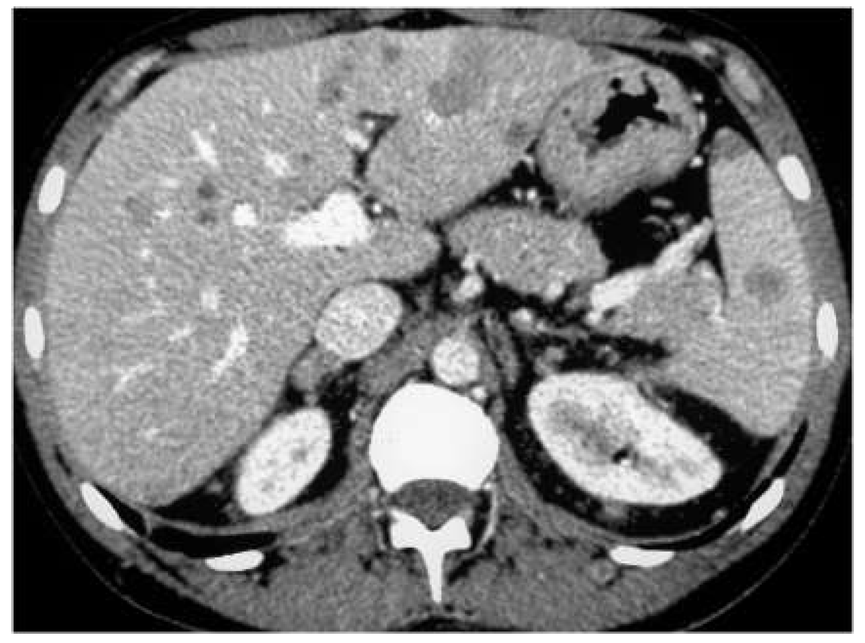 Incidental Focal Spleen Lesions: Integrated Imaging and Pattern ...