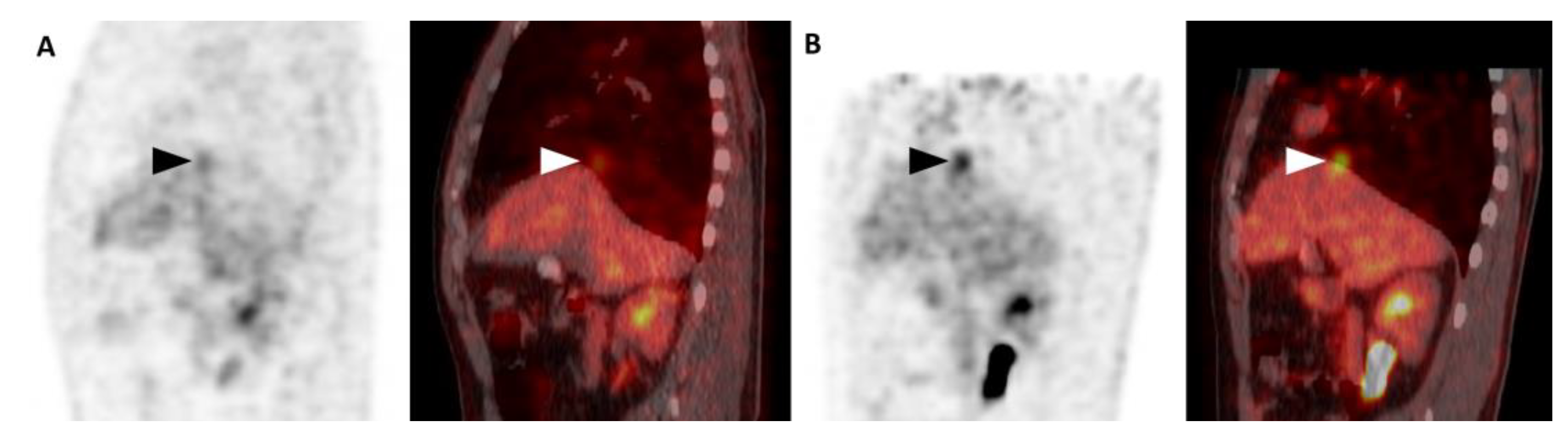 Diagnostics | Free Full-Text | Is Prone Position [18F]FDG PET/CT Useful ...
