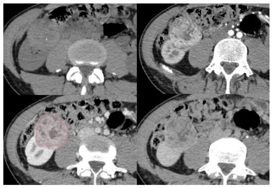 A CT-Based Clinical, Radiological and Radiomic Machine Learning Model ...