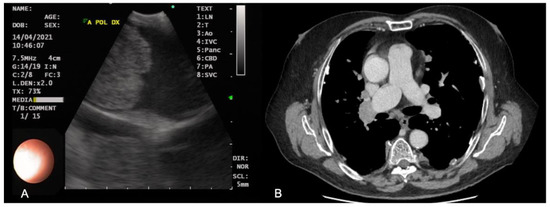 Clinical Applications of Endobronchial Ultrasound (EBUS) Scope ...