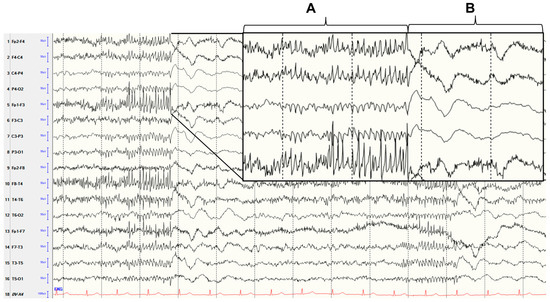 Generalized Polyspike Pattern in EEG Due to Aseptic Meningoencephalitis