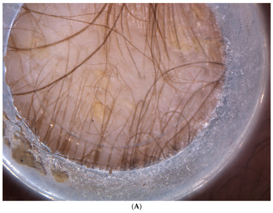 Congenital Cutis Verticis Gyrata in a Newborn with Turner Syndrome: A ...