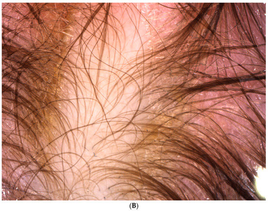 Congenital Cutis Verticis Gyrata in a Newborn with Turner Syndrome: A ...