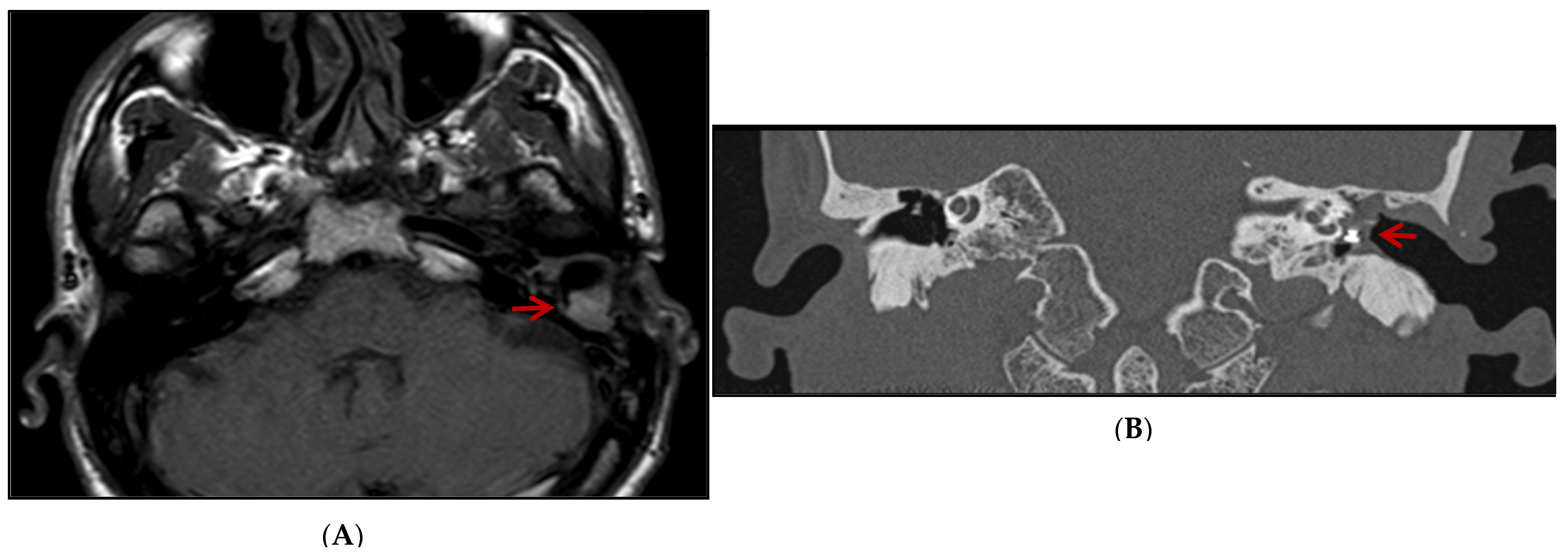 Nasal Myiasis: Case Report and Literature Review📛 Bem-vindo ao mundo ... Nasal Myiasis: Case Report and Literature Review📛 Bem-vindo ao mundo ...