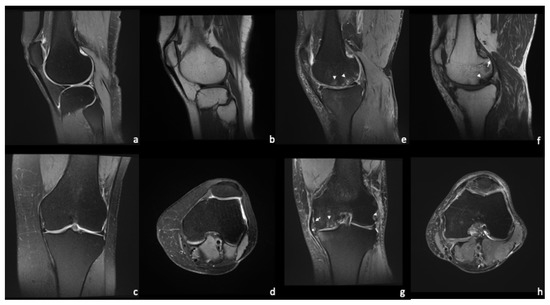 MR-Imaging in Osteoarthritis: Current Standard of Practice and Future ...