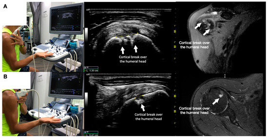 Infraspinatus Fascial Dysfunction as a Cause of Painful Anterior ...