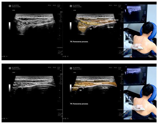 Infraspinatus Fascial Dysfunction as a Cause of Painful Anterior ...