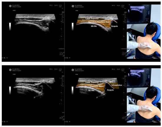 Infraspinatus Fascial Dysfunction as a Cause of Painful Anterior ...