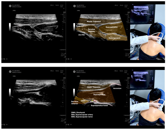 Infraspinatus Fascial Dysfunction as a Cause of Painful Anterior ...