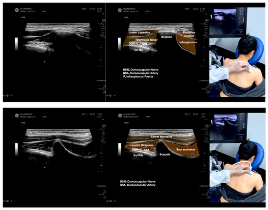Infraspinatus Fascial Dysfunction as a Cause of Painful Anterior ...