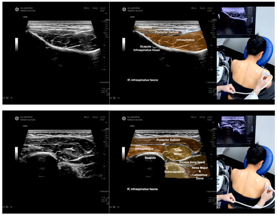 Infraspinatus Fascial Dysfunction as a Cause of Painful Anterior ...