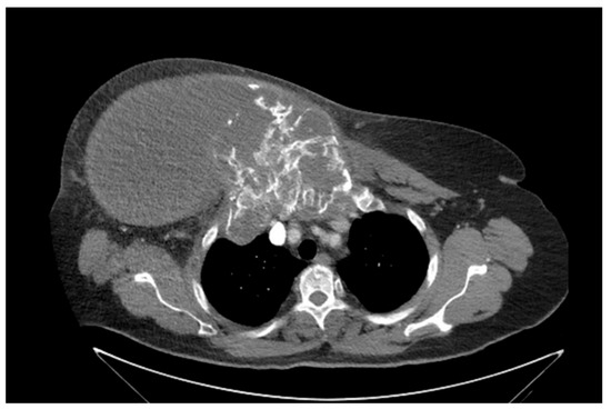 Cutaneous Metastasis of Endometrial Cancer and Long-Term Survival: A ...