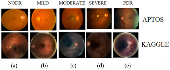 Automatic Detection and Classification of Diabetic Retinopathy Using ...