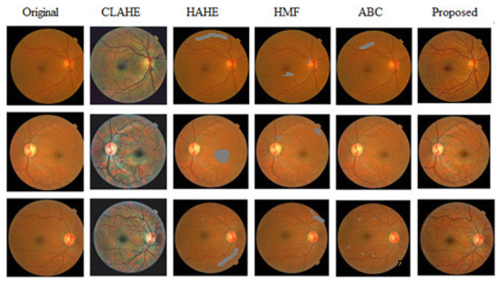 Automatic Detection and Classification of Diabetic Retinopathy Using the Improved Pooling ...