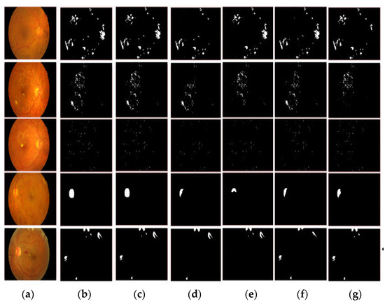 Automatic Detection and Classification of Diabetic Retinopathy Using ...