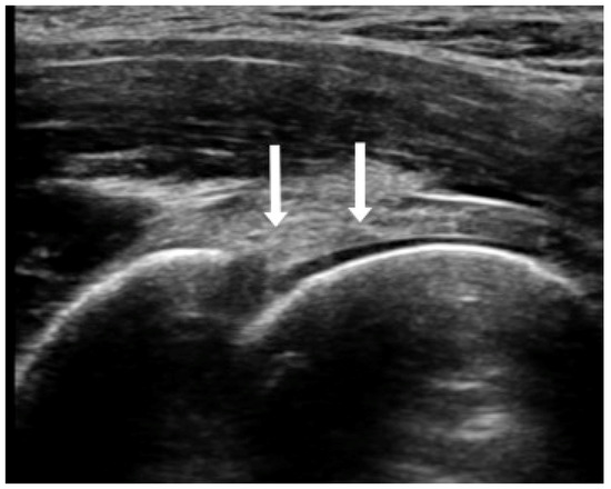 The Role of Ultrasonography in Hip Impingement Syndromes: A Narrative ...