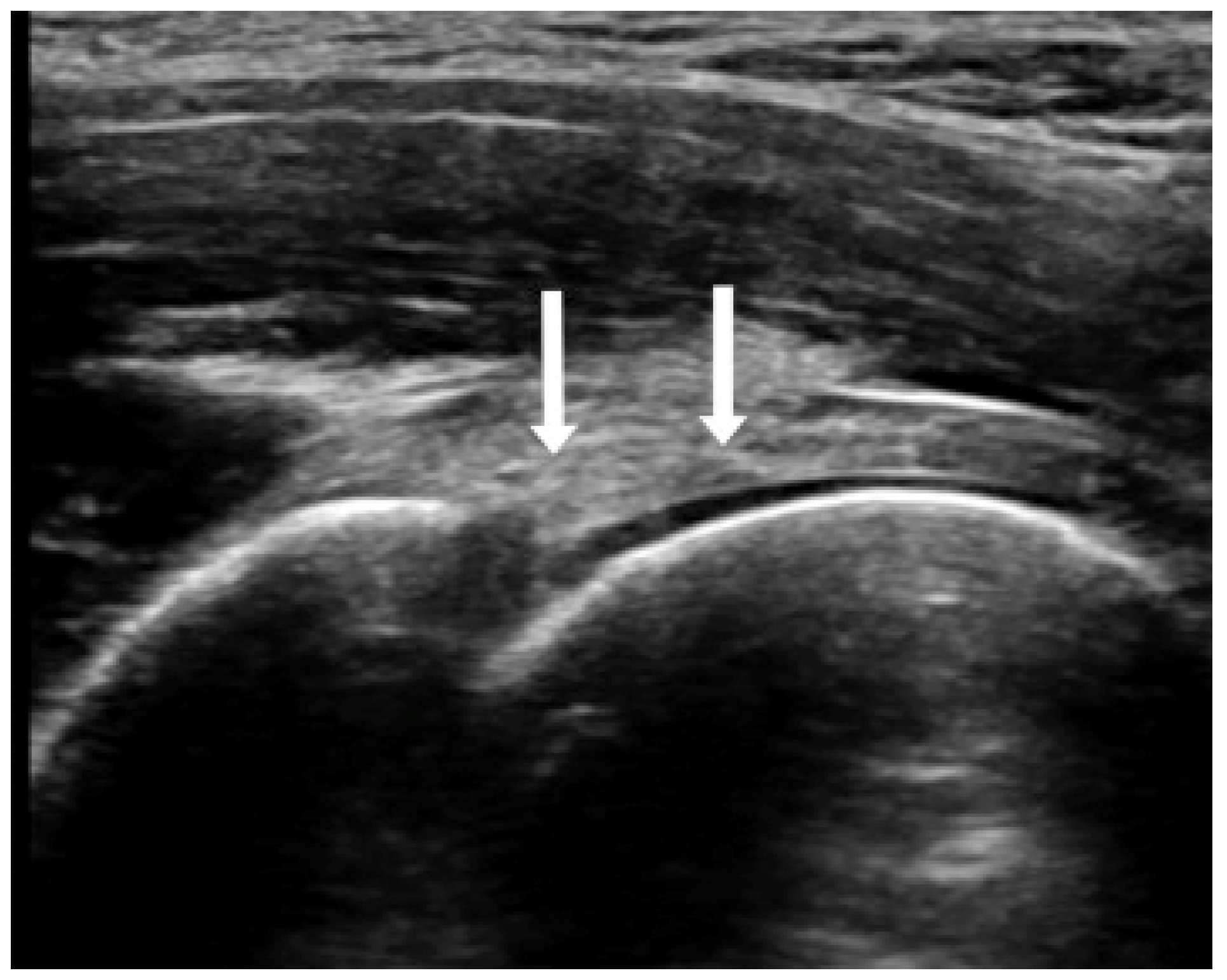 Diagnostics Free Full Text The Role Of Ultrasonography In Hip