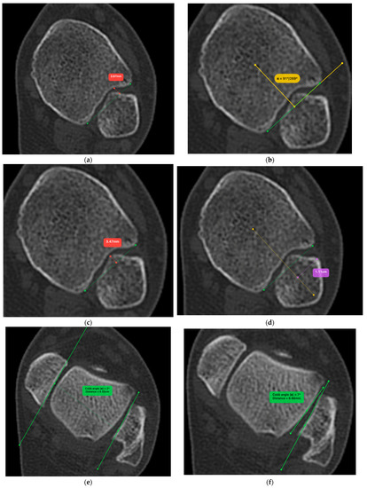 Anterior Incisura Fibularis Corner Landmarks Can Safely Validate the ...