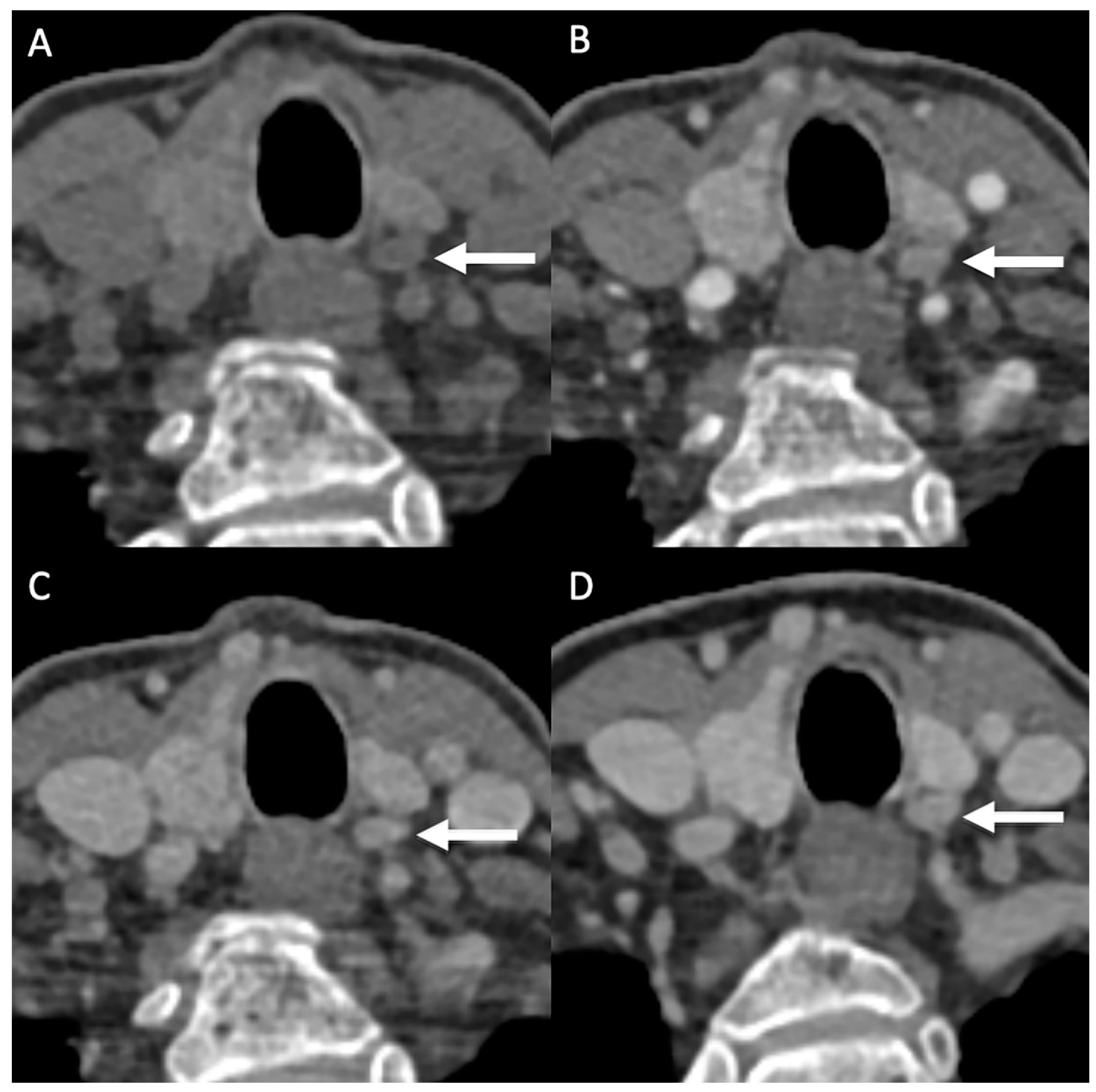 Diagnostic Value of Four-Dimensional Dynamic Computed Tomography for ...