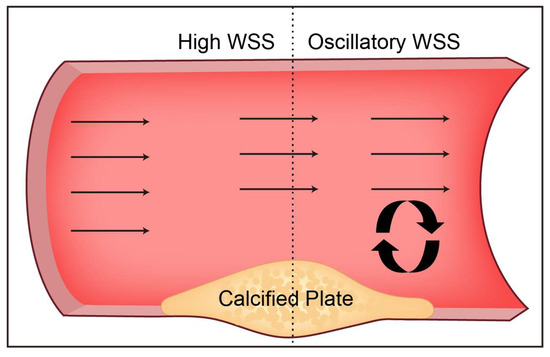 Mechanism Analysis of Vascular Calcification Based on Fluid Dynamics