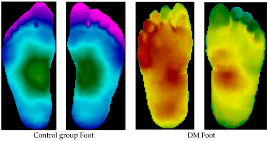 Automatic Diabetic Foot Ulcer Recognition Using Multi-Level Thermographic Image Data
