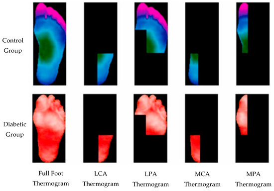 Automatic Diabetic Foot Ulcer Recognition Using Multi-Level Thermographic Image Data