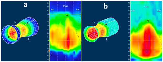 Study on 3D High-Resolution Anorectal Manometry Interrater Agreement in ...