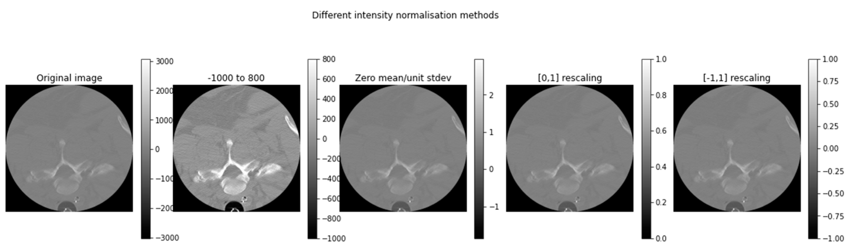 An Automated Deep Learning Approach for Spine Segmentation and Vertebrae Recognition Using ...
